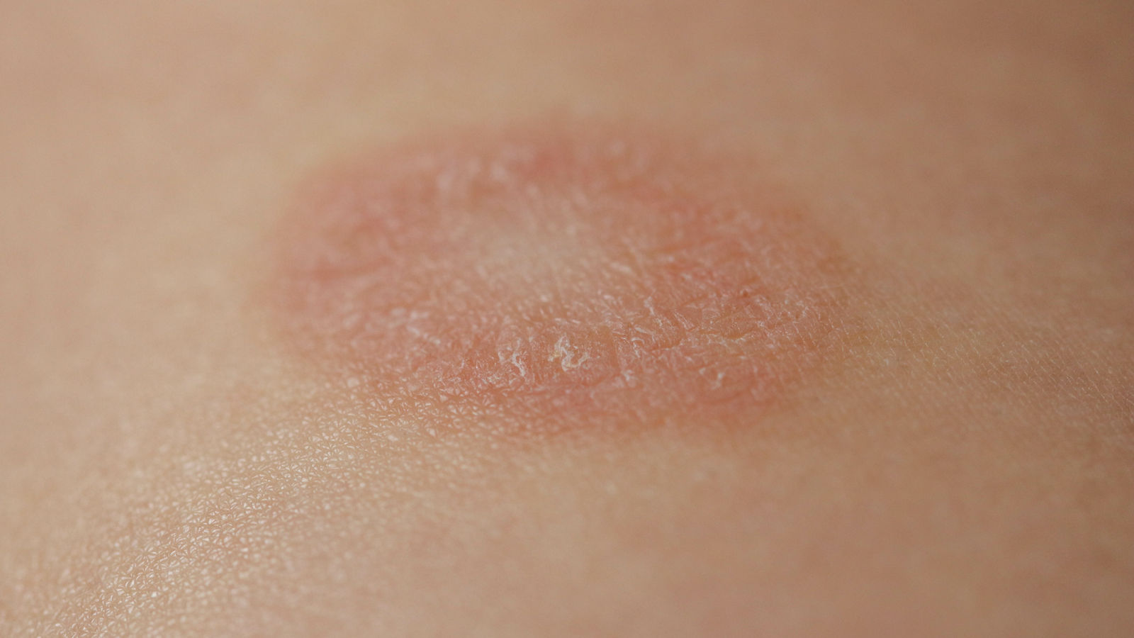 Röschenflechte: Hautrötungen bei Pityriasis rosea erklärt | Helios ...