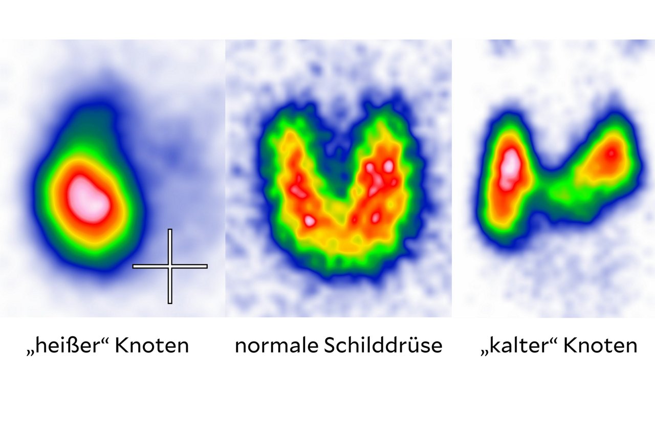 Funktionsszintigraphie der Schilddrüse | Helios Klinikum Erfurt