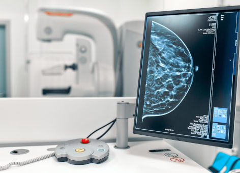Comprendre la mammographie - Fiches info patients